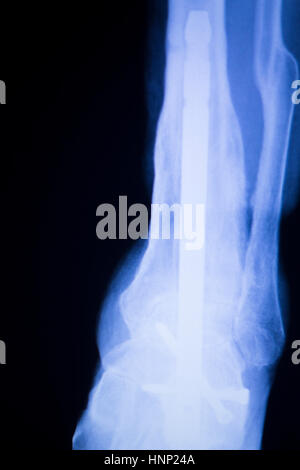 Xray foot heel ankle test scan results showing orthopedic titanium ...