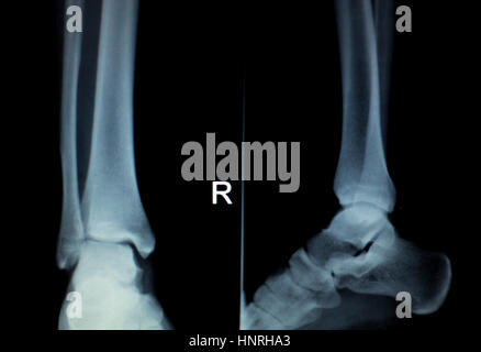 Xray foot heel ankle test scan results showing orthopedic titanium ...