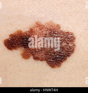 Close-up of skin cancer (melanoma) on the cheek of the face in an 83 ...