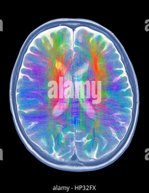 Computer artwork of MRI top view of brain showing white matter fibres ...