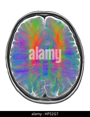 Computer artwork of MRI top view of brain showing white matter fibres.Coloured 3D diffusion ...