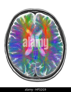 Computer artwork of MRI top view of brain showing white matter fibres ...