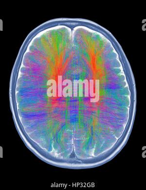 Computer artwork of MRI top view of brain showing white matter fibres ...