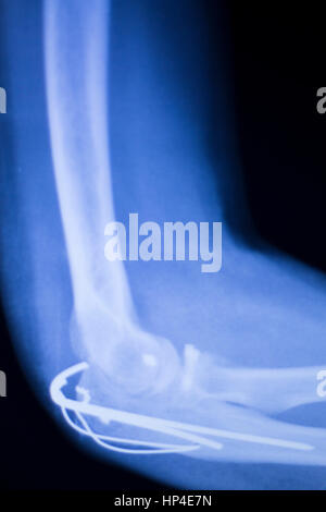 Elbow, arm and forearm orthopedic titanium metal replacement implant ...