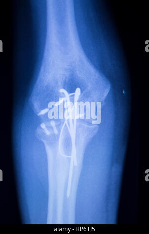 Elbow joint titanium metal modern implant x-ray test scan result after ...