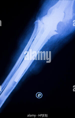 Elbow joint titanium metal modern implant x-ray test scan result after ...