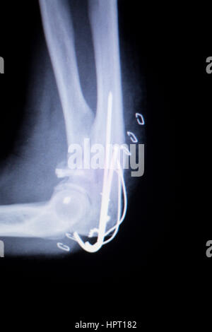 Elbow joint titanium metal modern implant x-ray test scan result after ...
