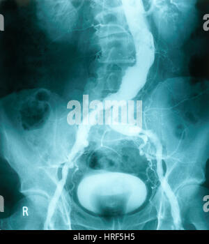 Atheroma in Aorta and Iliac Arteries Stock Photo - Alamy