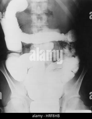 Spinal Cord, Ulcerative Colitis, X-ray Stock Photo - Alamy