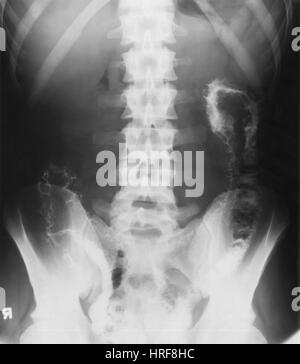 ULCERATIVE COLITIS, X-RAY Stock Photo - Alamy