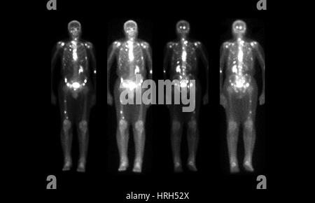 Nuclear Medicine Bone Scan Stock Photo - Alamy