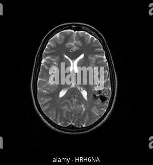 MRI of Brain AVM Stock Photo - Alamy