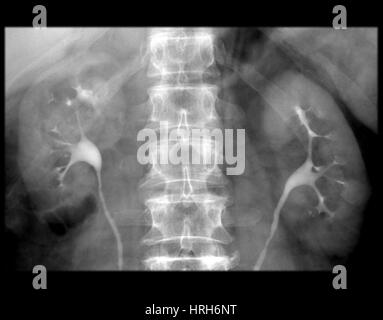 Normal Xray of Urinary Bladder Stock Photo: 134988166 - Alamy