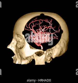 3D Image of Skull and Brain AVM Stock Photo - Alamy