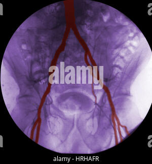 Angiogram of Iliac Arteries Stock Photo - Alamy