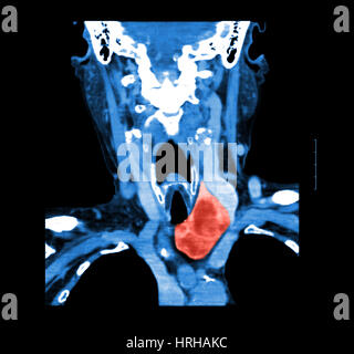 CT of Neck Showing Thyroid Goiter Stock Photo - Alamy