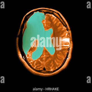 MRI Shows Near Total Hemispherectomy Stock Photo - Alamy
