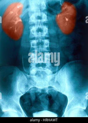 Normal Xray of Urinary Bladder Stock Photo: 134988166 - Alamy