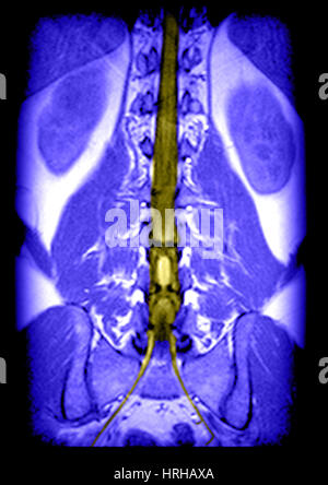 MRI of Normal Sacrum Stock Photo - Alamy