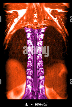 Normal MRI of Thoracic Spinal Cord Stock Photo - Alamy