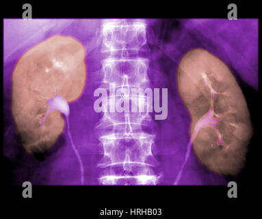 Normal Xray of Urinary Bladder Stock Photo - Alamy