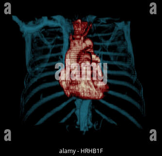 3D CT Reconstruction of Heart Stock Photo - Alamy