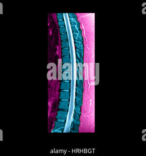 Normal MRI of Thoracic Spinal Cord Stock Photo - Alamy