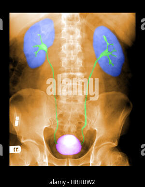 IVP of Normal Kidneys Stock Photo - Alamy