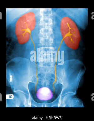 IVP of Normal Kidneys Stock Photo - Alamy