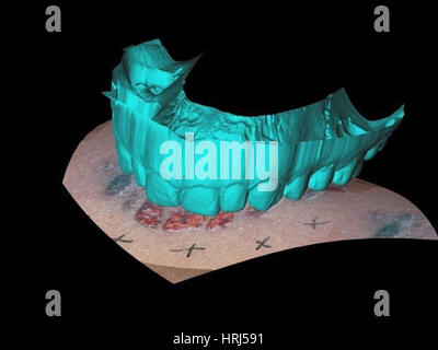Computer Reconstruction of Bite Mark Stock Photo - Alamy
