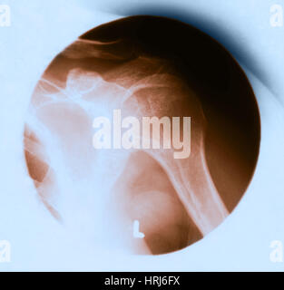 Normal shoulder joint, X-ray Stock Photo - Alamy