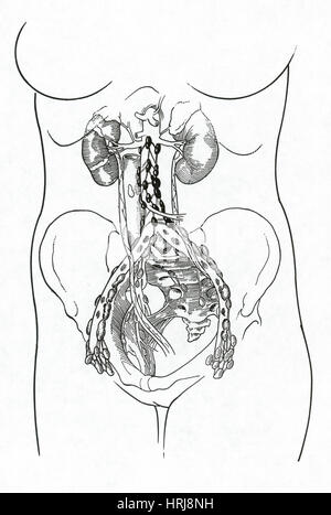 LYMPH NODE, DRAWING Stock Photo - Alamy