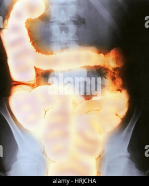 Spinal Cord, Ulcerative Colitis, X-ray Stock Photo - Alamy