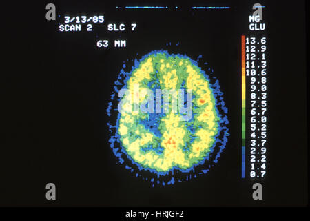 PET Scan of Normal Brain Stock Photo - Alamy