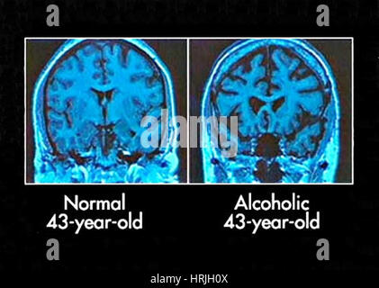 Normal brain, MRI scans Stock Photo: 40085344 - Alamy