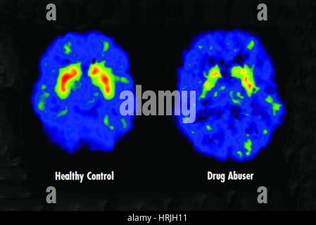 PET Scans of Normal and Abnormal Brains Stock Photo - Alamy