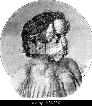 Joseph Carey Merrick (1862-1890) was an English man with severe ...