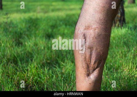 Old scar of leg injury, from car or motorbike accident, deep tissue ...