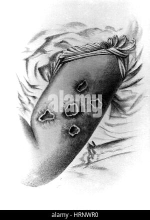 Smallpox Pustules, 1898 Stock Photo - Alamy