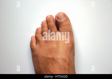 Figure out the nail, Accident nail trauma, Foot ulcers, Onychocryptosis ...