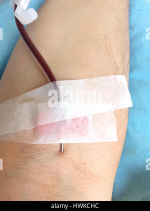 patient arm during blood transfusion with the needle in the skin Stock ...