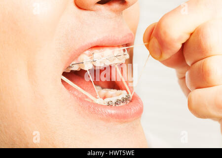 Man put on orthodontic rubber strings on a braces for correcting a bite ...