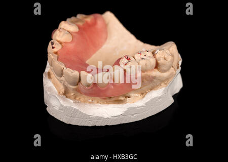 Dentures, partial dentures on plaster model Stock Photo - Alamy