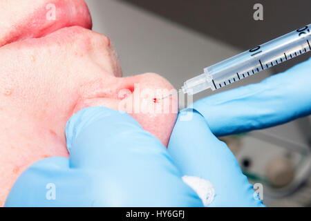 Microsurgery: Local anesthesia on the nose Stock Photo - Alamy