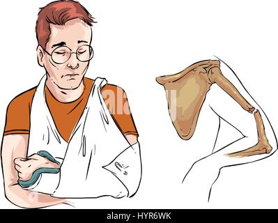 fracture arm guy vector Stock Vector Image & Art - Alamy