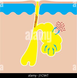 Acne vulgaris or pimple. The sebum and dead skin cells in the clogged ...