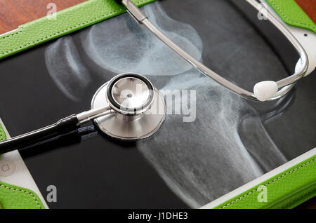 x-ray image on ipad tablet screen monitor of leg femur Stock Photo - Alamy