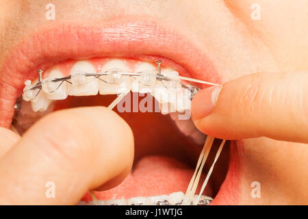 Man put on orthodontic latex rubber ring string for correcting jaw and ...