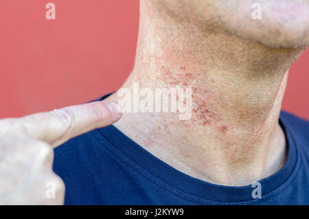 Scar on the neck of a man after removal of the thyroid gland, close-up ...
