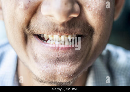 A boy showing his dirty teeth Stock Photo - Alamy